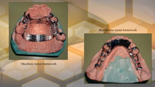 An altered cast procedure to improve tissue support | PPTX