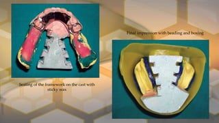 An altered cast procedure to improve tissue support | PPTX