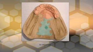 An altered cast procedure to improve tissue support | PPTX