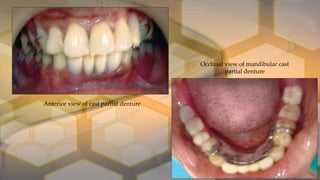 An altered cast procedure to improve tissue support | PPTX