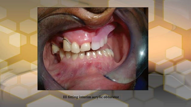 An altered cast procedure to improve tissue support | PPTX