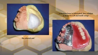 An altered cast procedure to improve tissue support | PPTX