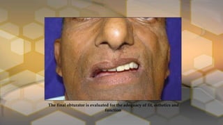 An altered cast procedure to improve tissue support | PPTX