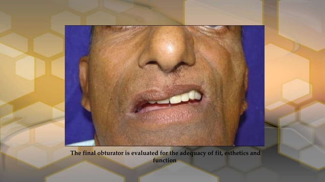 An altered cast procedure to improve tissue support | PPTX