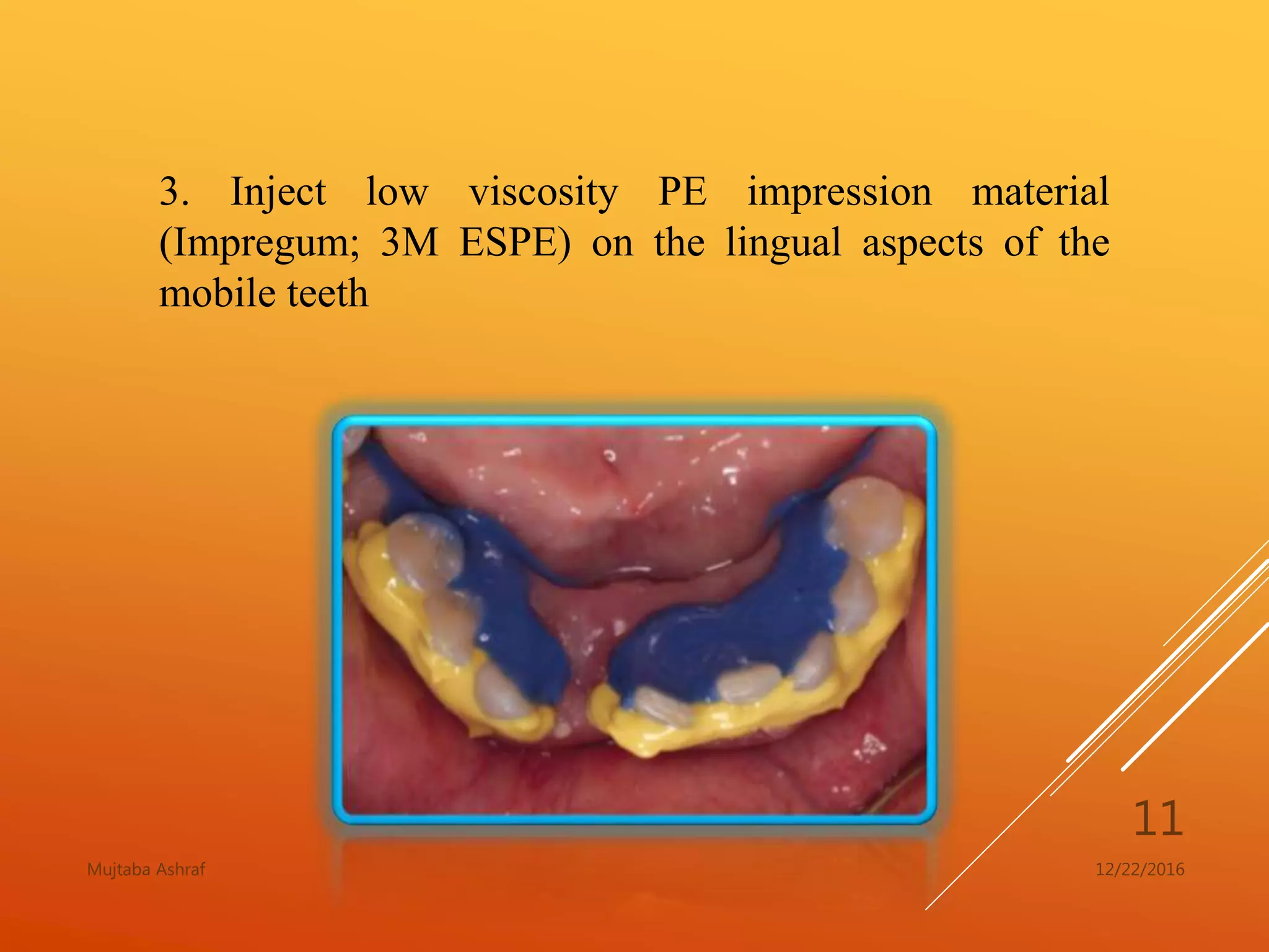 An alternative impression technique for mobile teeth | PPTX