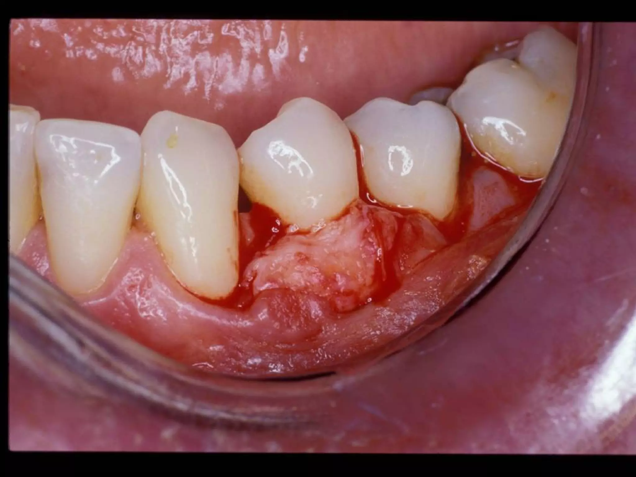 An Alternative To Autogenous Connective Tissue Grafting For Root Coverage Ppt
