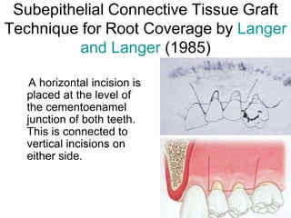An Alternative to Autogenous Connective Tissue Grafting for Root ...