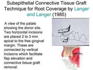 An Alternative to Autogenous Connective Tissue Grafting for Root ...