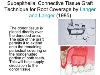 An Alternative to Autogenous Connective Tissue Grafting for Root ...