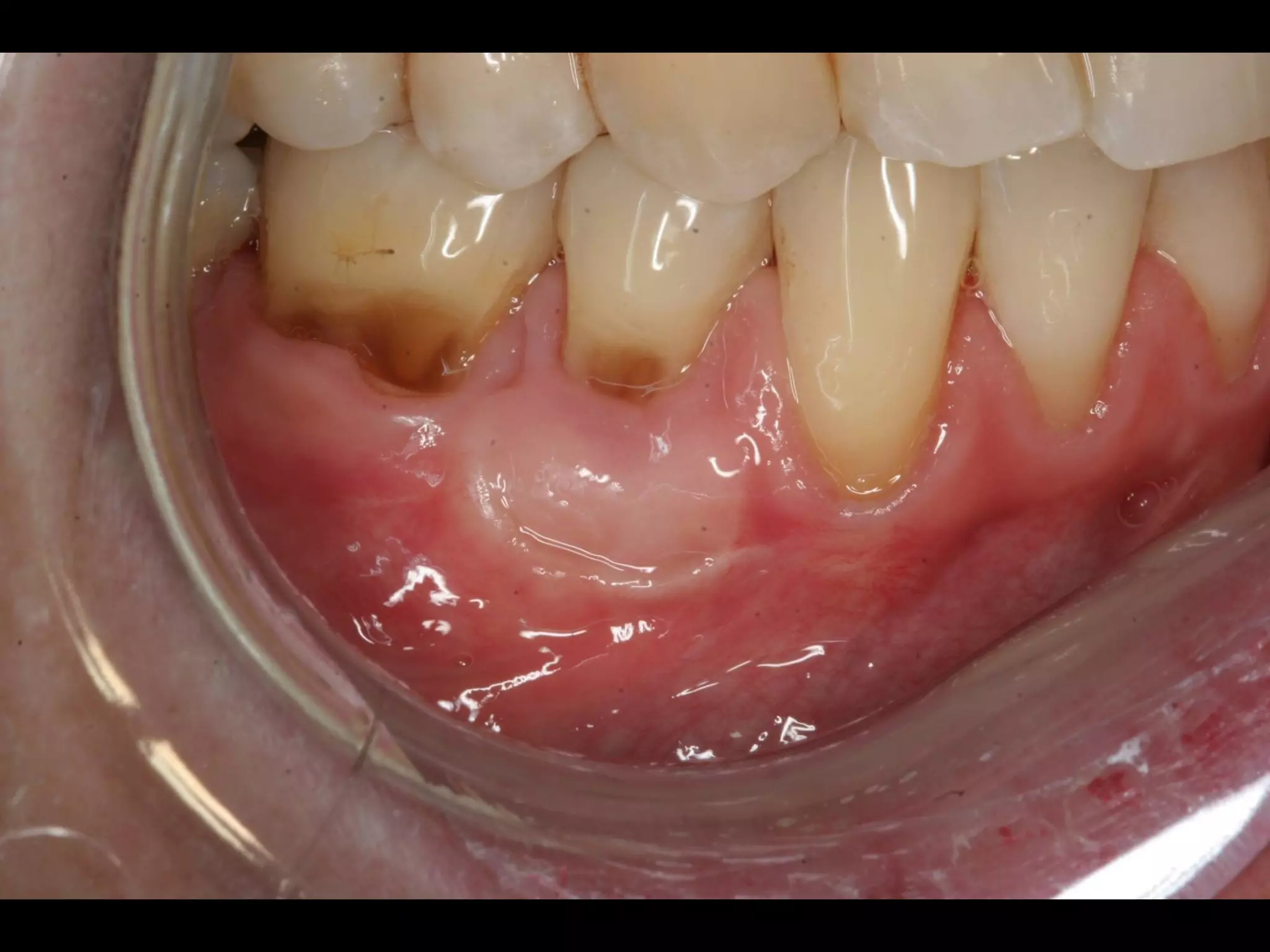 An Alternative To Autogenous Connective Tissue Grafting For Root Coverage Ppt