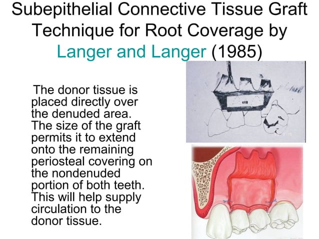 An Alternative To Autogenous Connective Tissue Grafting For Root