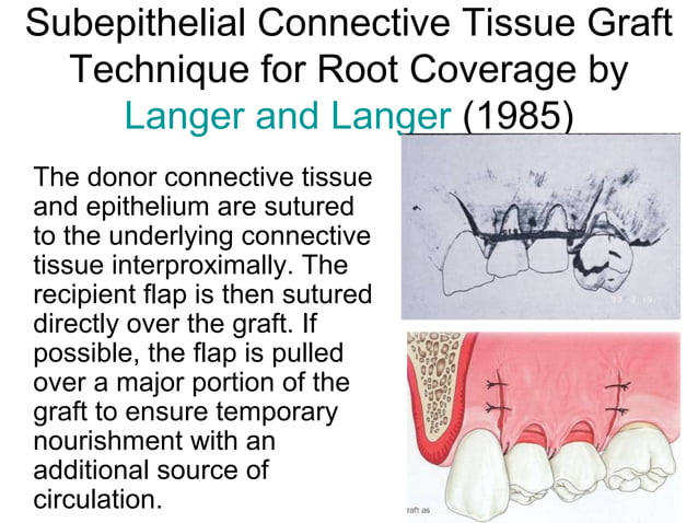 An Alternative To Autogenous Connective Tissue Grafting For Root Coverage Ppt
