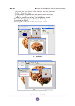 Analysis of Alzheimer’s Disease Using Color Image Segmentation | PDF