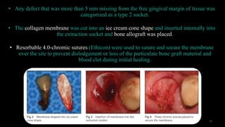 Analysis of buccolingual dimensional changes of the extraction socket ...