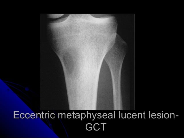 Analysis Of Focal Lucent Bony Lesion