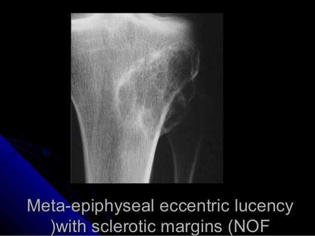 Analysis of focal lucent bony lesion