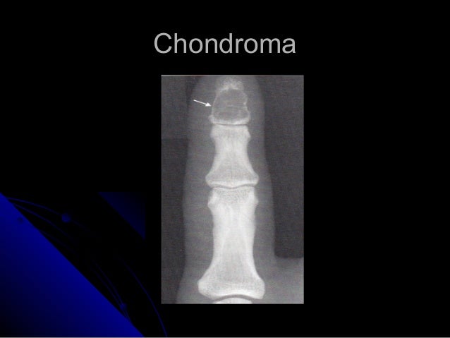 Analysis Of Focal Lucent Bony Lesion