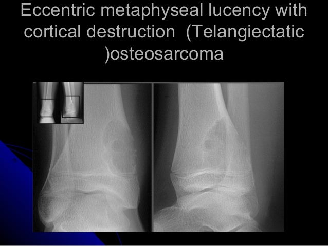 Analysis of focal lucent bony lesion