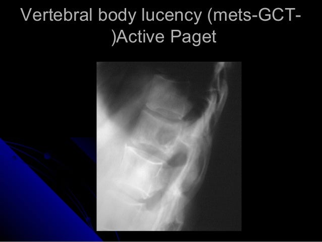 Analysis of focal lucent bony lesion