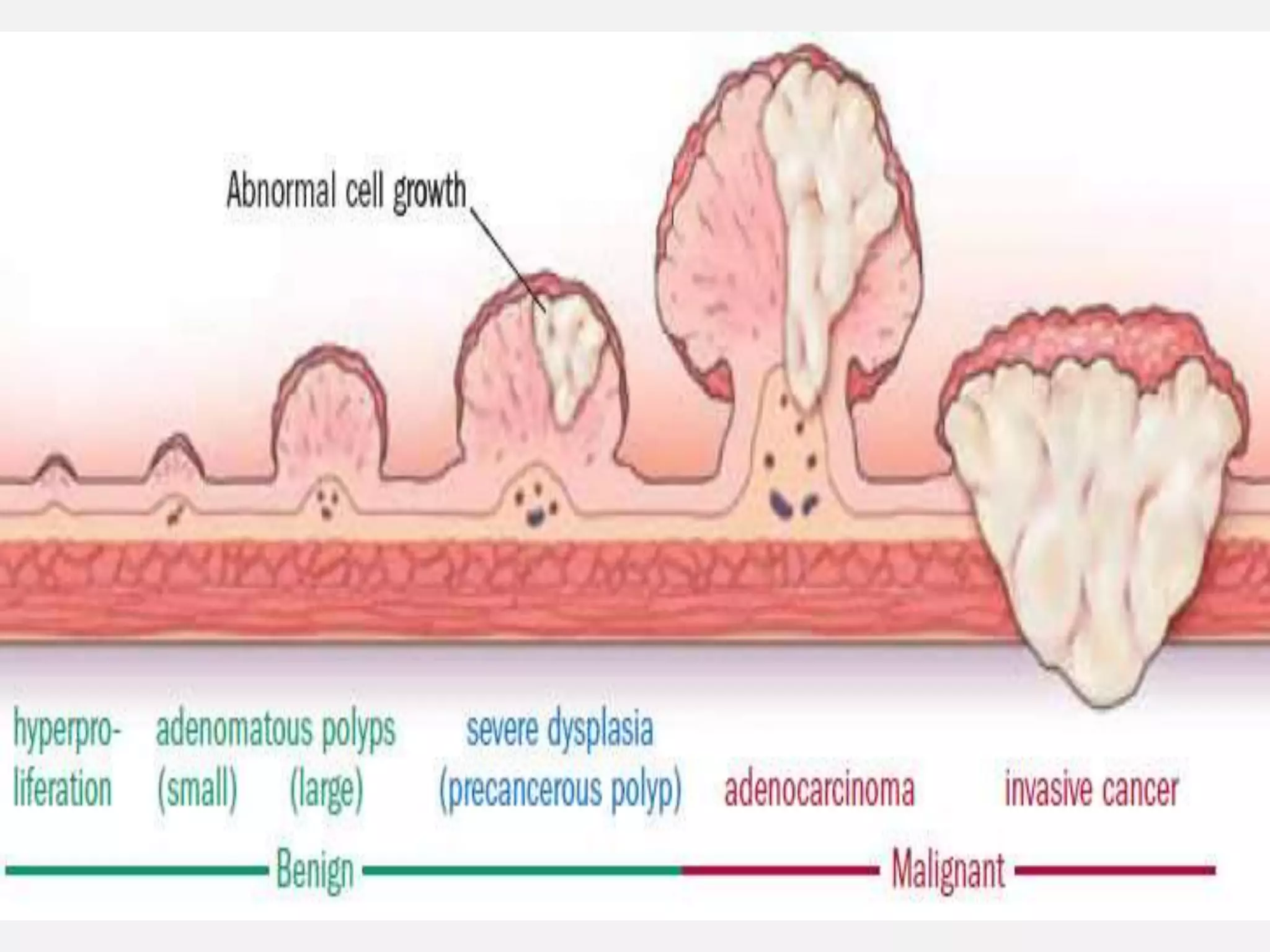 Benign & malignant growth Pathology | PPTX