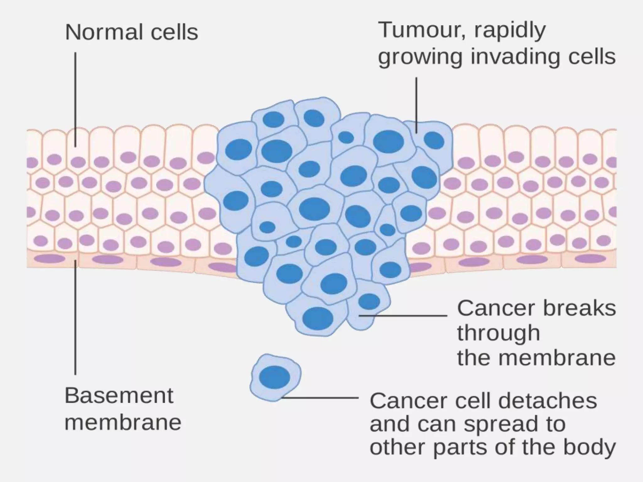 Benign & malignant growth Pathology | PPTX