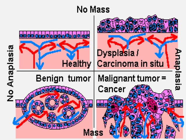 Benign & malignant growth Pathology | PPTX