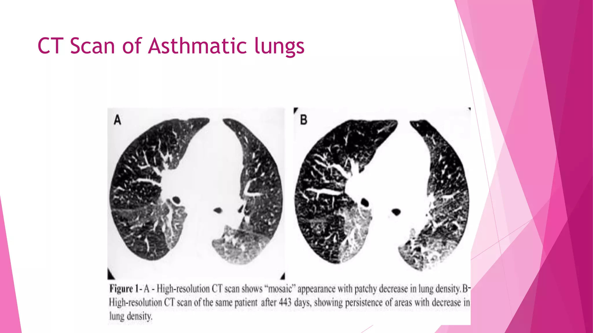 Bronchial asthma Pediatrics Topic | PPTX