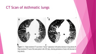 Bronchial asthma Pediatrics Topic | PPTX