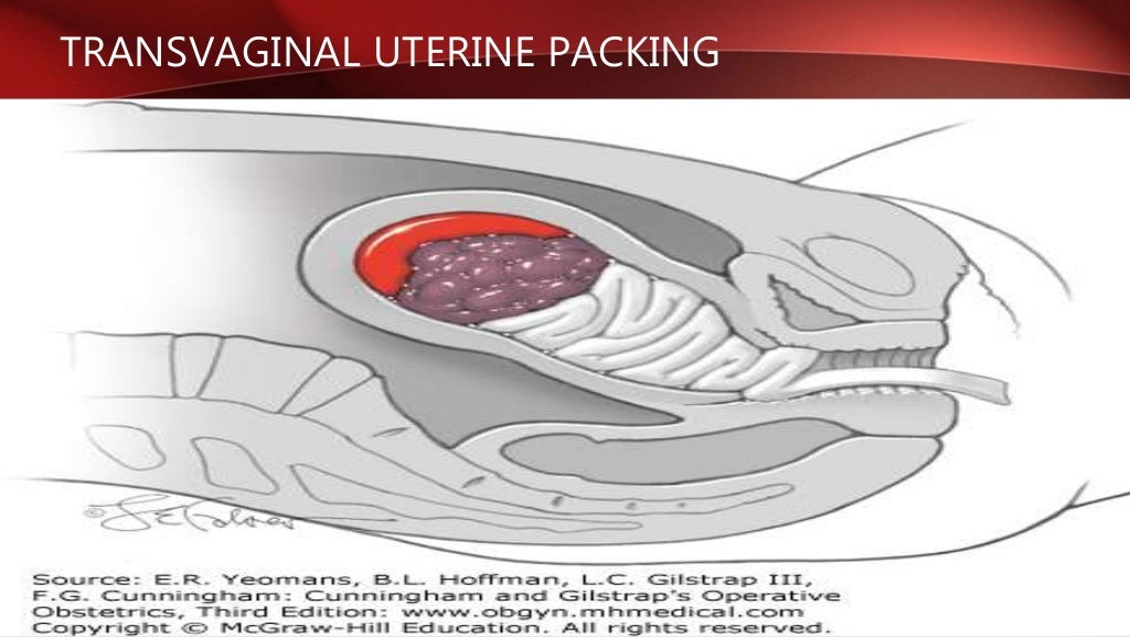 Postpartum hemorrhage