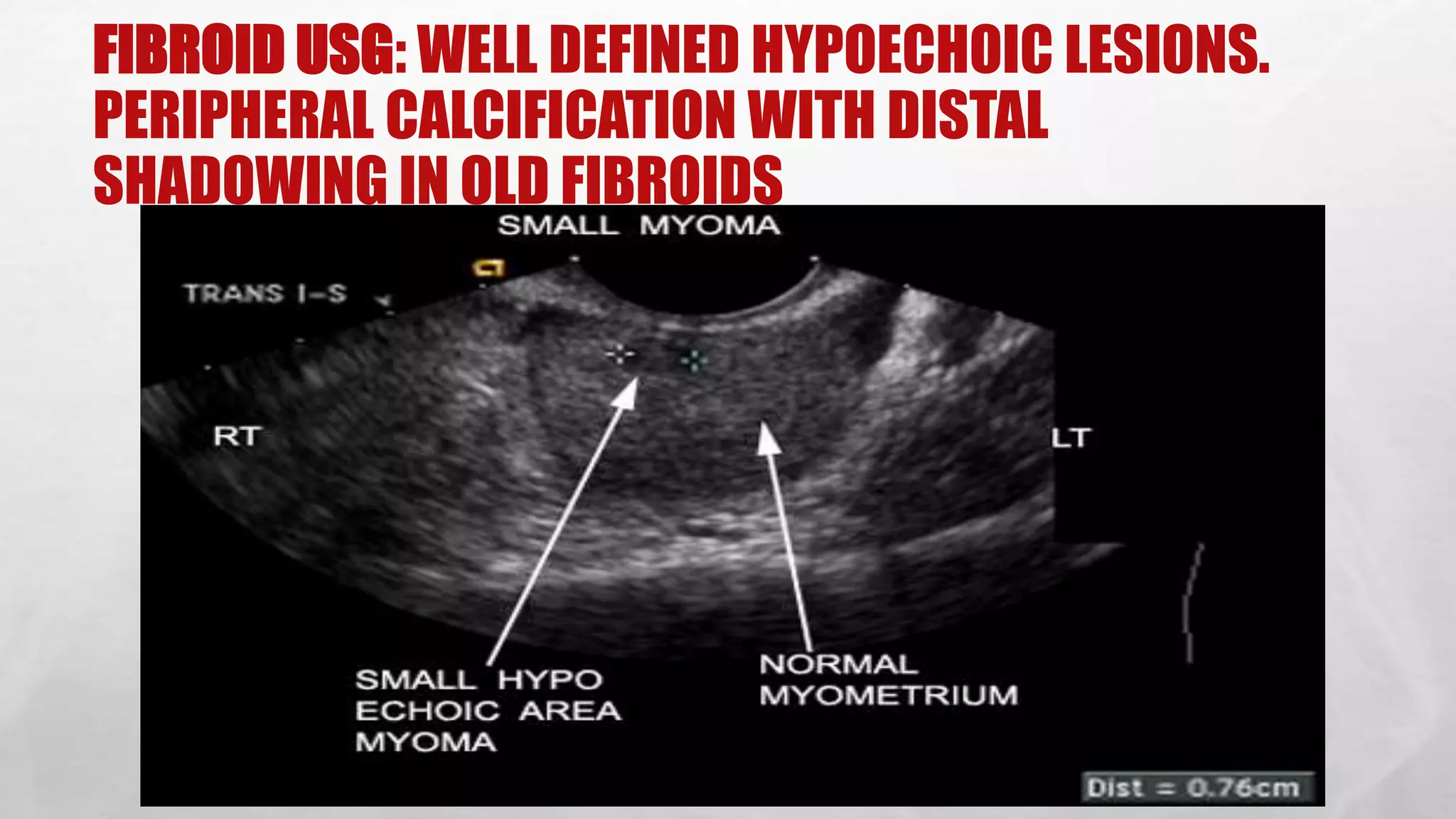 Uterine fibroids introduction and Management | PPTX