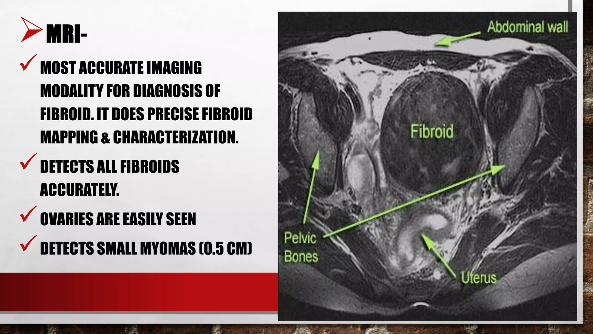 Uterine fibroids introduction and Management | PPTX
