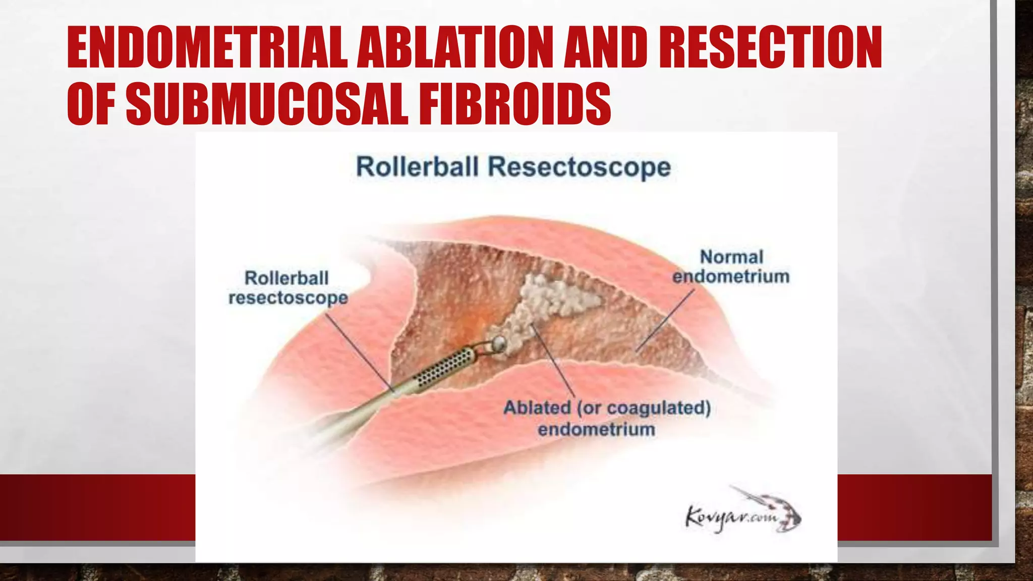 Uterine fibroids introduction and Management | PPTX