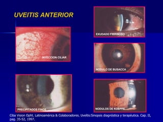 Anamnesis, Signos Y SíNtomas. Uveitis | PPT