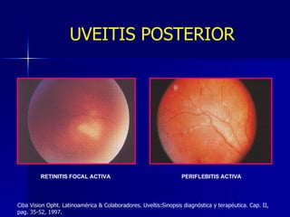 Anamnesis, Signos Y SíNtomas. Uveitis | PPT