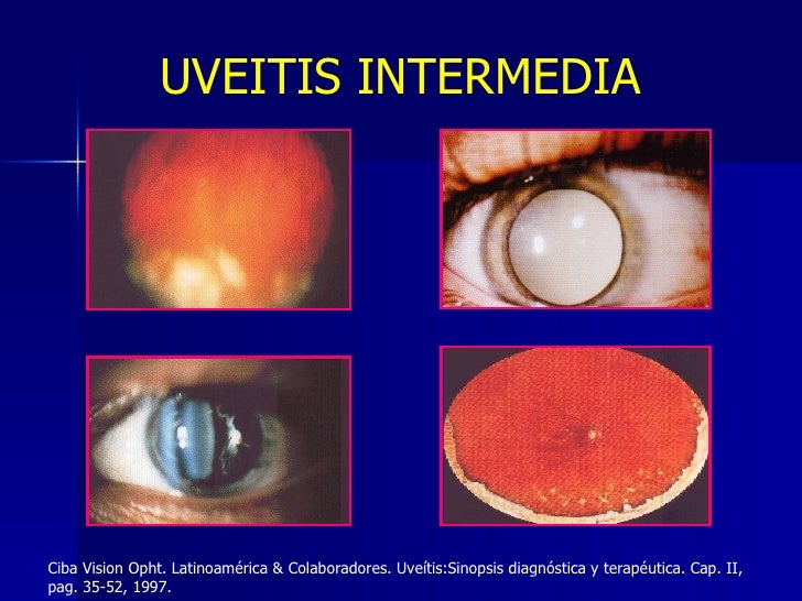 Anamnesis, Signos Y SíNtomas. Uveitis