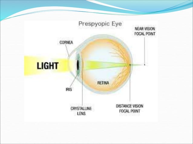 Anomalies of accommodation | PPT | Eye and Vision Conditions | Diseases ...