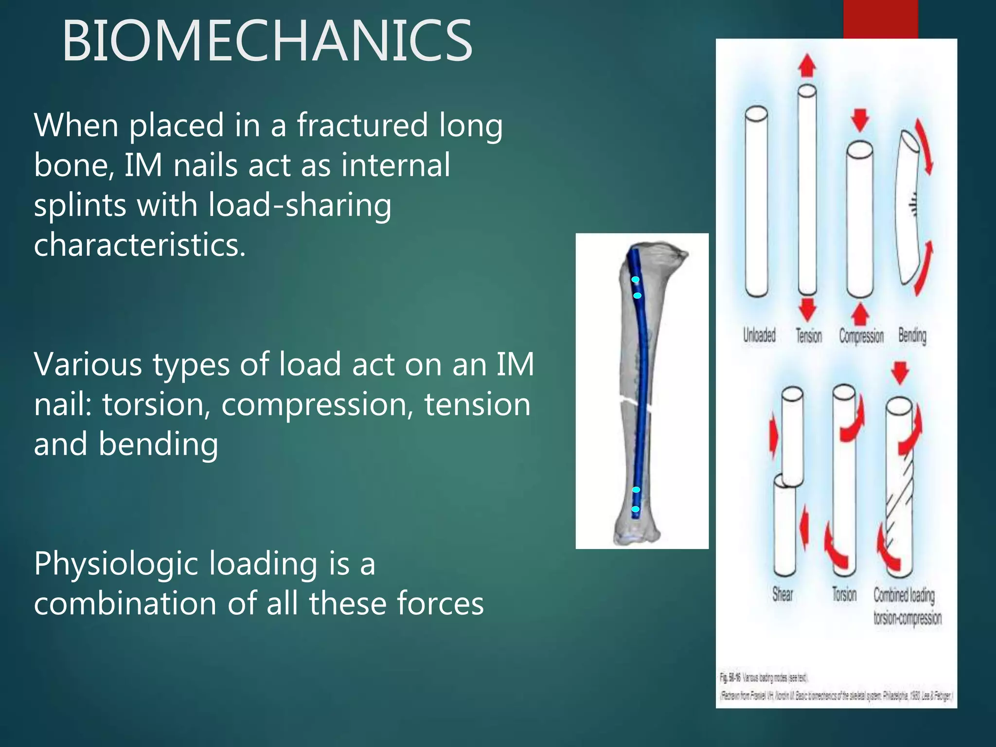 intramedullary nailing | PPTX