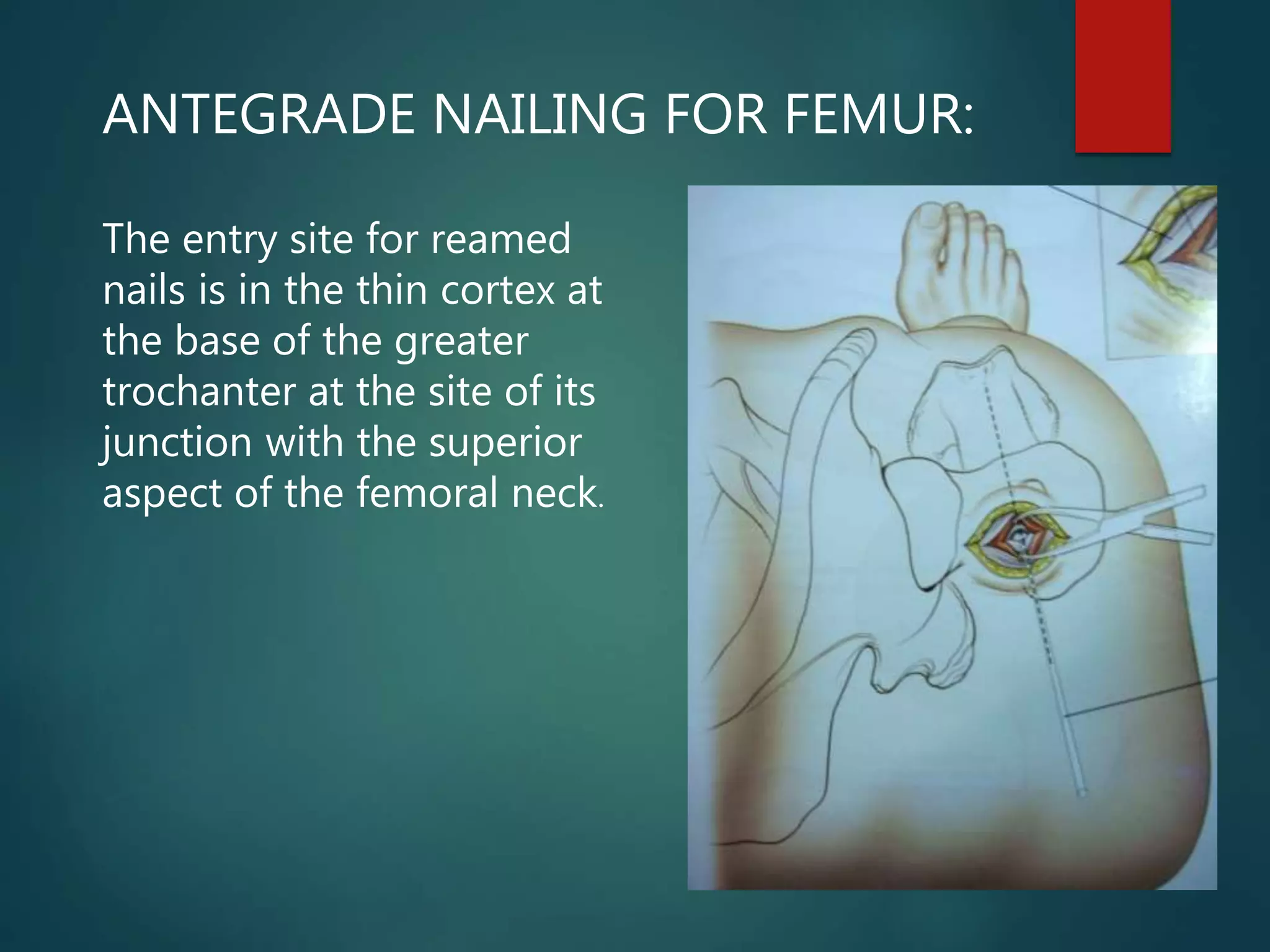 intramedullary nailing | PPTX