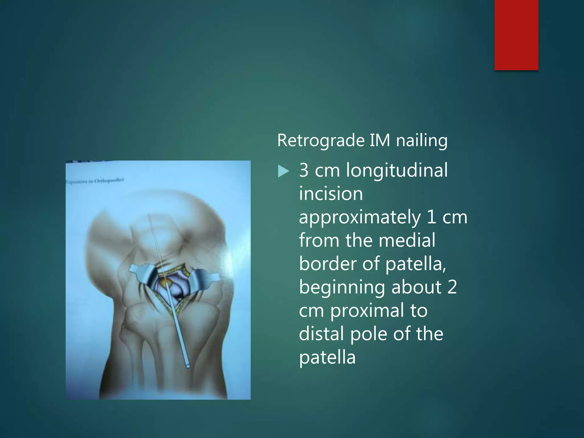 intramedullary nailing | PPTX