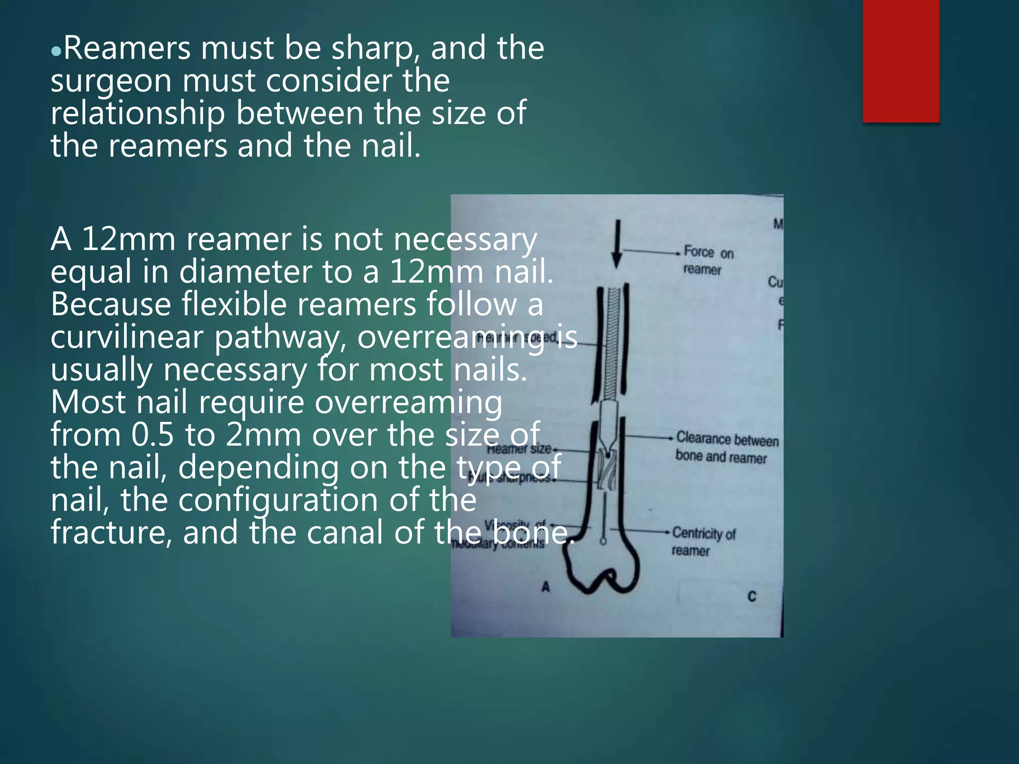 intramedullary nailing | PPTX