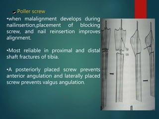 intramedullary nailing | PPTX