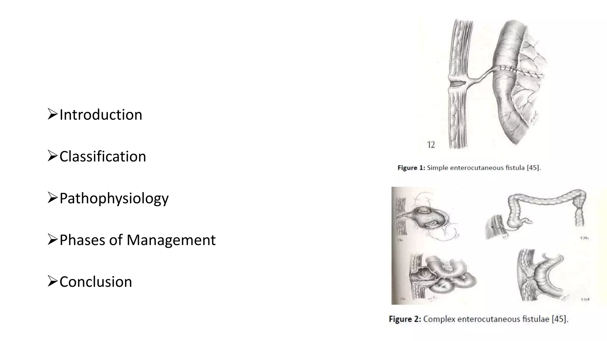 ENTEROCUTANEOUS FISTULA | PPTX