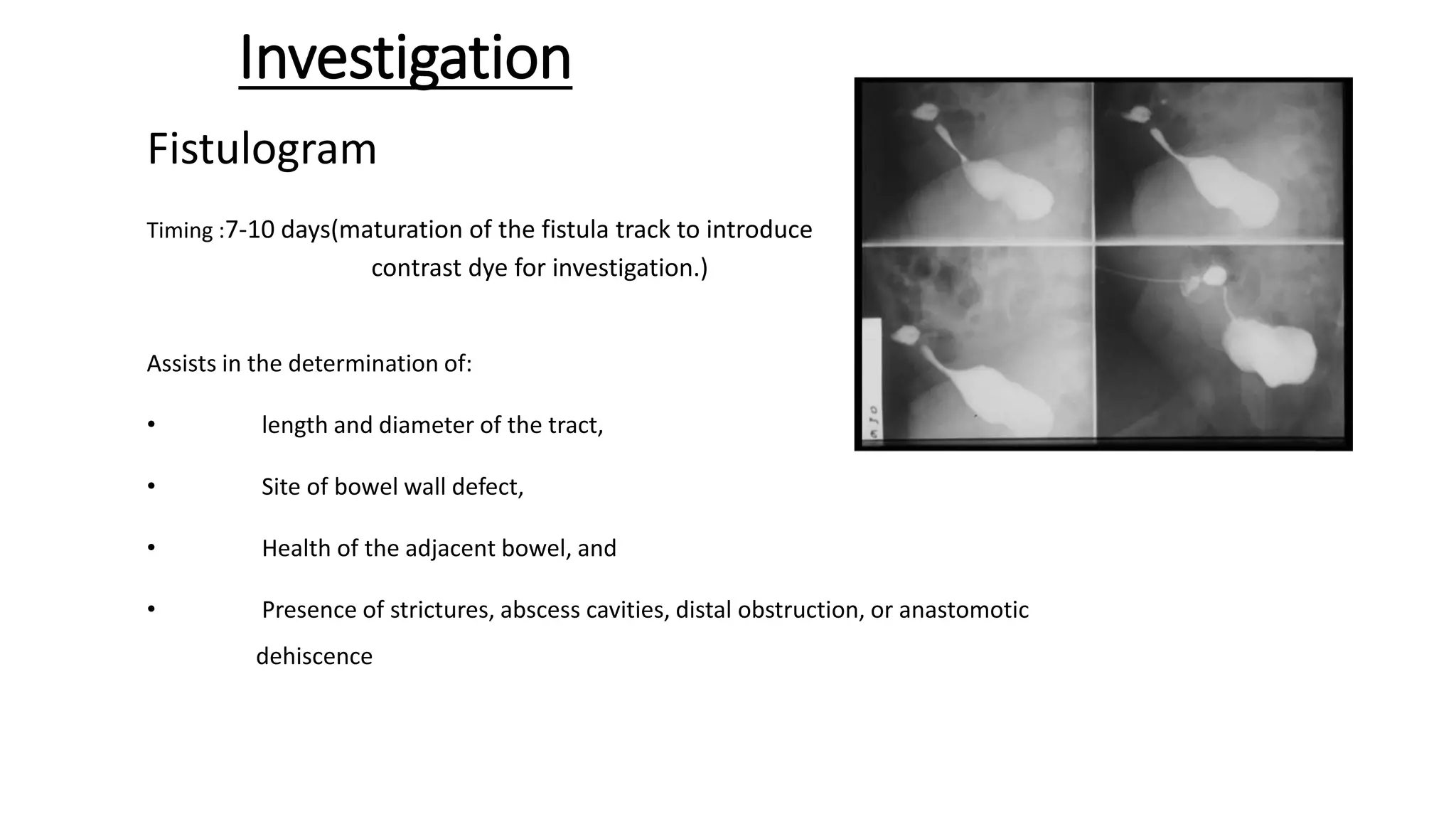 ENTEROCUTANEOUS FISTULA | PPTX