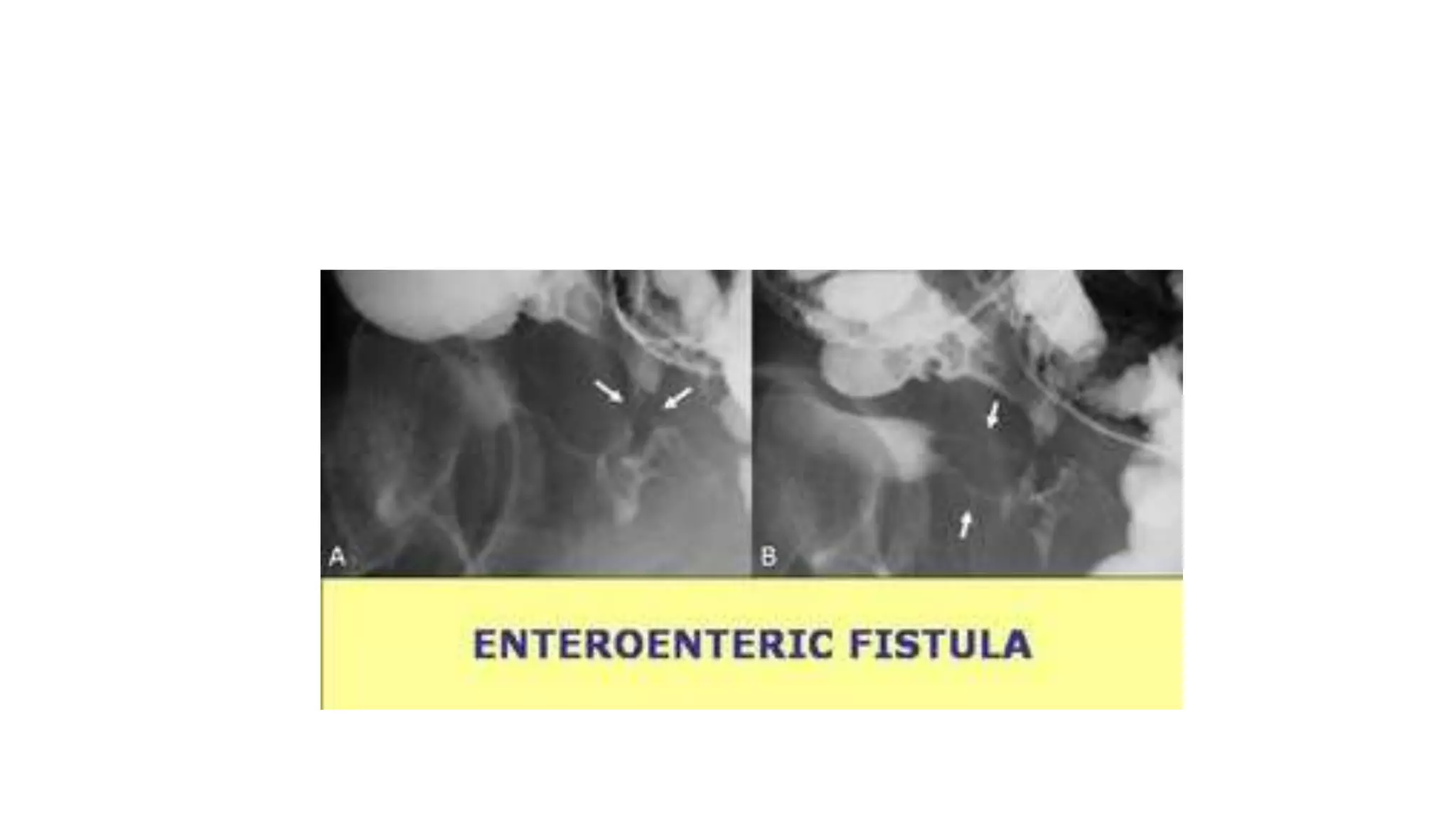 ENTEROCUTANEOUS FISTULA | PPTX