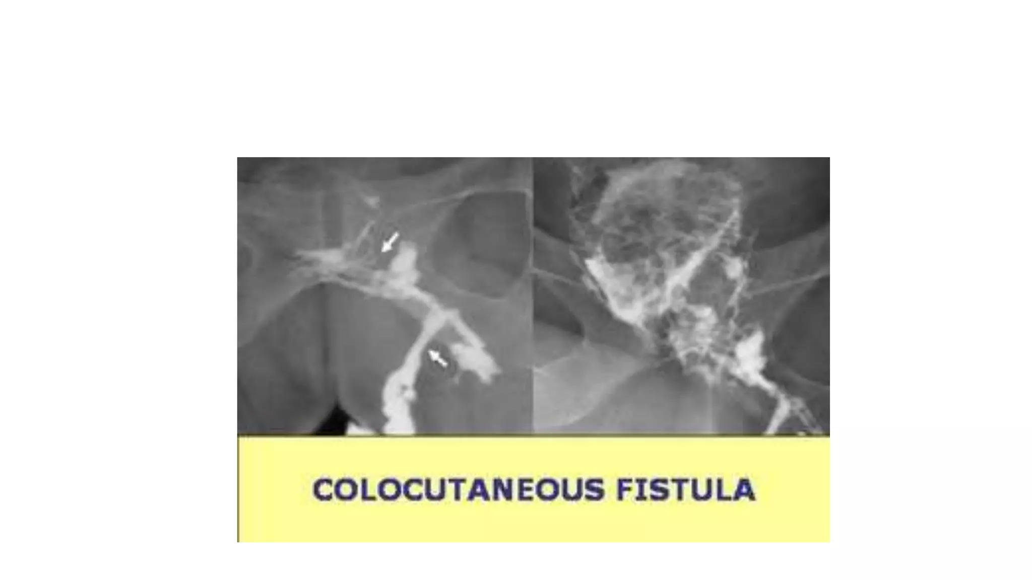 ENTEROCUTANEOUS FISTULA | PPTX