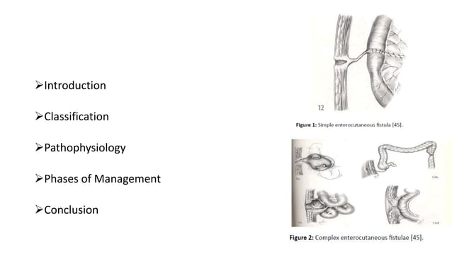 ENTEROCUTANEOUS FISTULA | PPTX