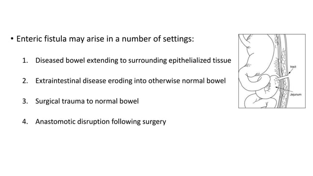 ENTEROCUTANEOUS FISTULA | PPTX