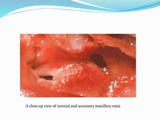 ANATOMY OF NOSE AND PNS.pptx