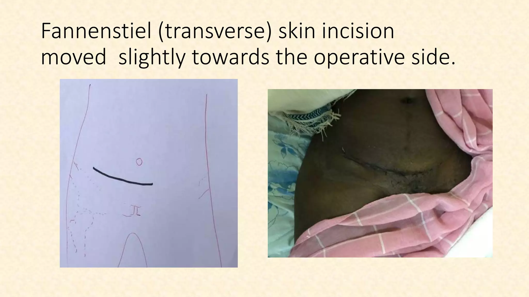 A new anterior acetabular approach | PPTX