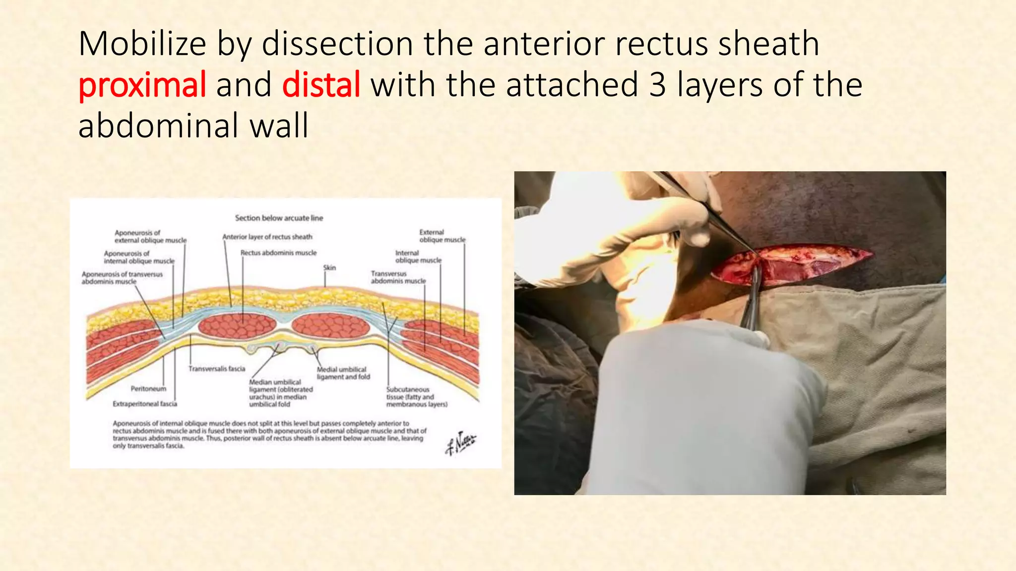 A new anterior acetabular approach | PPTX